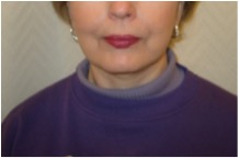 FACELIFT & NECK LIFTS - RHYTIDECTOMY