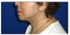 FACELIFT & NECK LIFTS - RHYTIDECTOMY