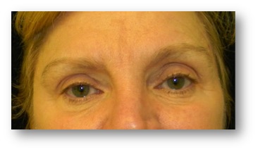 Botox and Fillers Photo Gallery