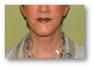 FACELIFT & NECK LIFTS - RHYTIDECTOMY