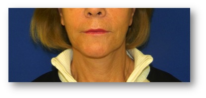 FACELIFT & NECK LIFTS - RHYTIDECTOMY