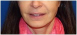 FACELIFT & NECK LIFTS - RHYTIDECTOMY