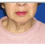 FACELIFT & NECK LIFTS - RHYTIDECTOMY