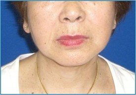 FACELIFT & NECK LIFTS - RHYTIDECTOMY