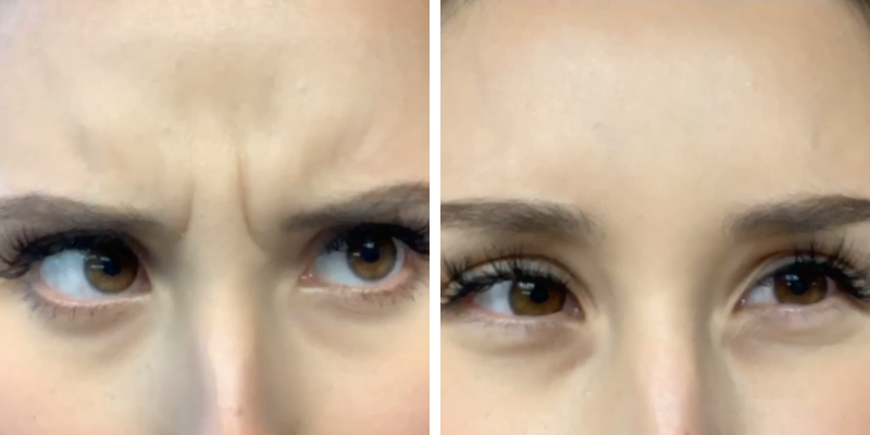 Botox and Fillers Photo Gallery | Botox Bethesda MD | Fillers